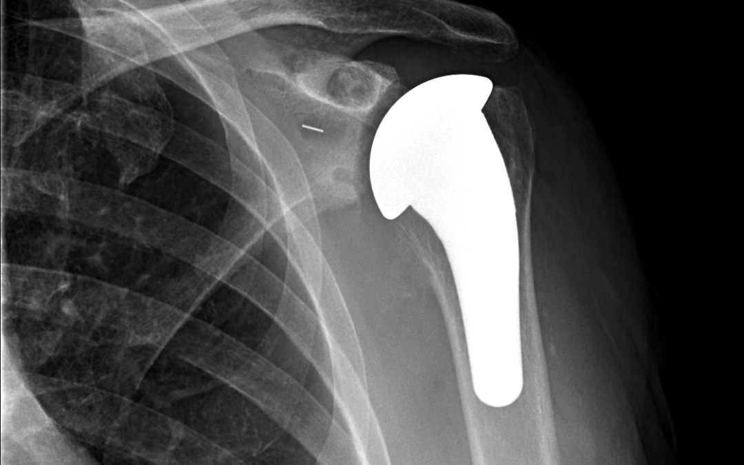 Understanding Total Shoulder Replacement The Center