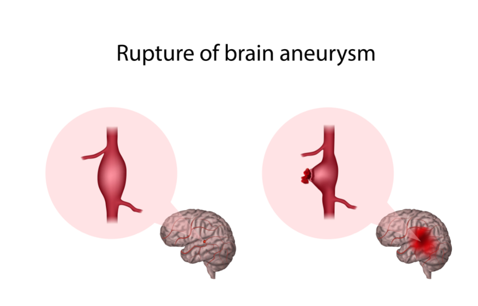 Early Warning Signs Of A Brain Aneurysm The Center Oregon